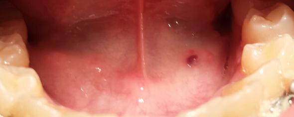 Blasen auf der Zunge - Symptome, Ursachen & Behandlung