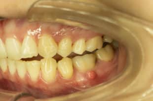 Eiterpickel im Mund Symptome, Risiken & Behandlungsmethoden